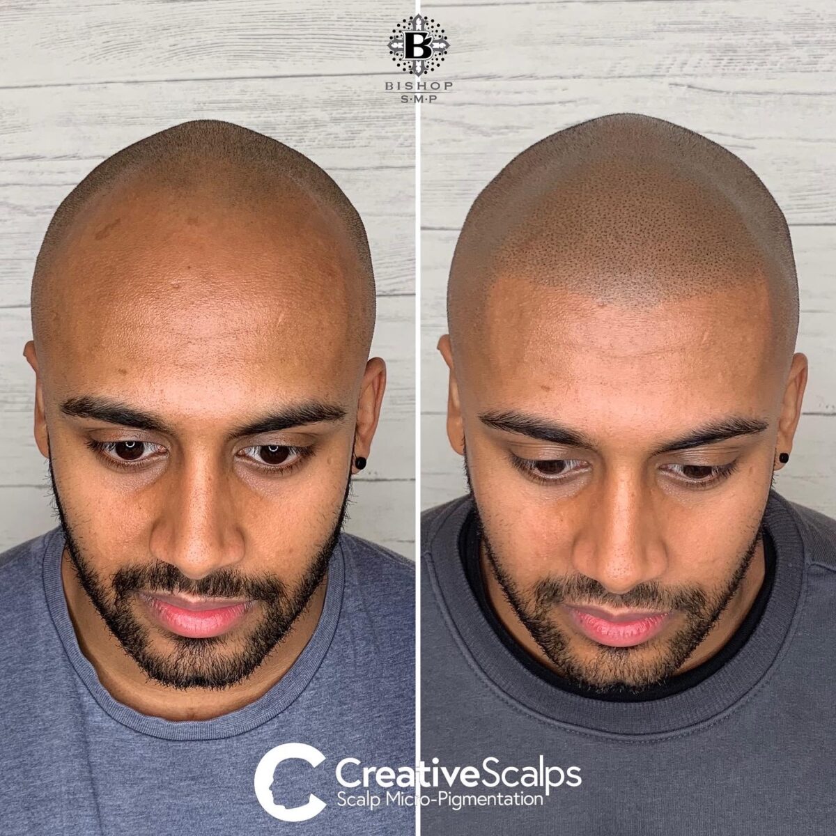 Faded Hairline Scalp Micropigmentation style by Creative Scalps